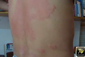 Urticaire et plus - DermatoMaroc