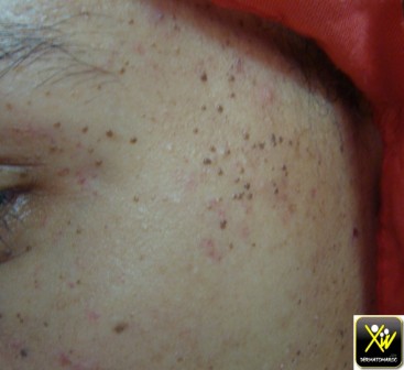 Dermocorticoides - DermatoMaroc