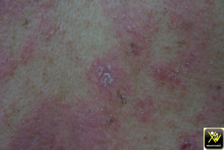 Erythrodermie mycosique. - DermatoMaroc