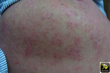 Erythrodermie mycosique. - DermatoMaroc
