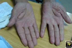 Attention cette Ichtyose est acquise! - DermatoMaroc