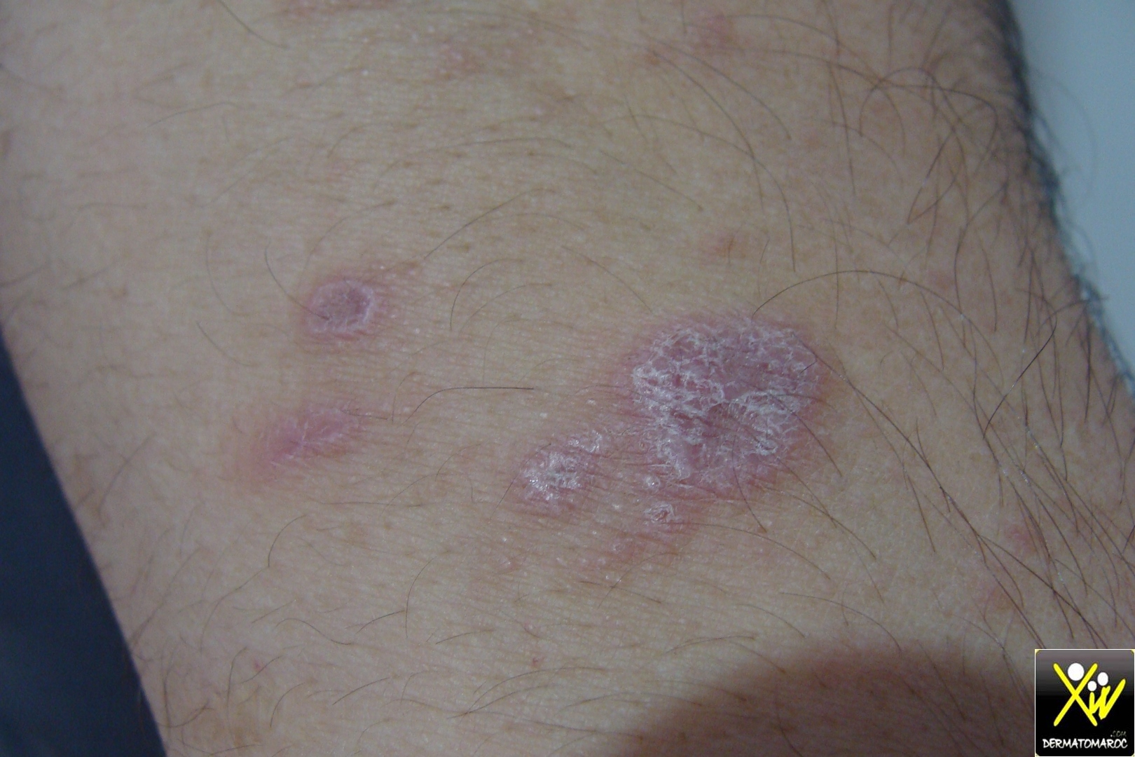 Papules prurigineuses diffuses. - DermatoMaroc