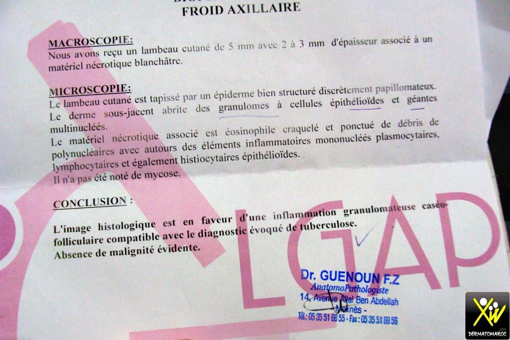 Intertrigo axillaire fistulisé. - DermatoMaroc